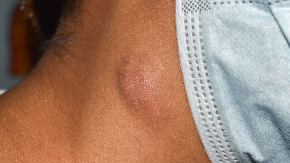 Lump on Neck: Causes, Symptoms & Effective Treatment Options